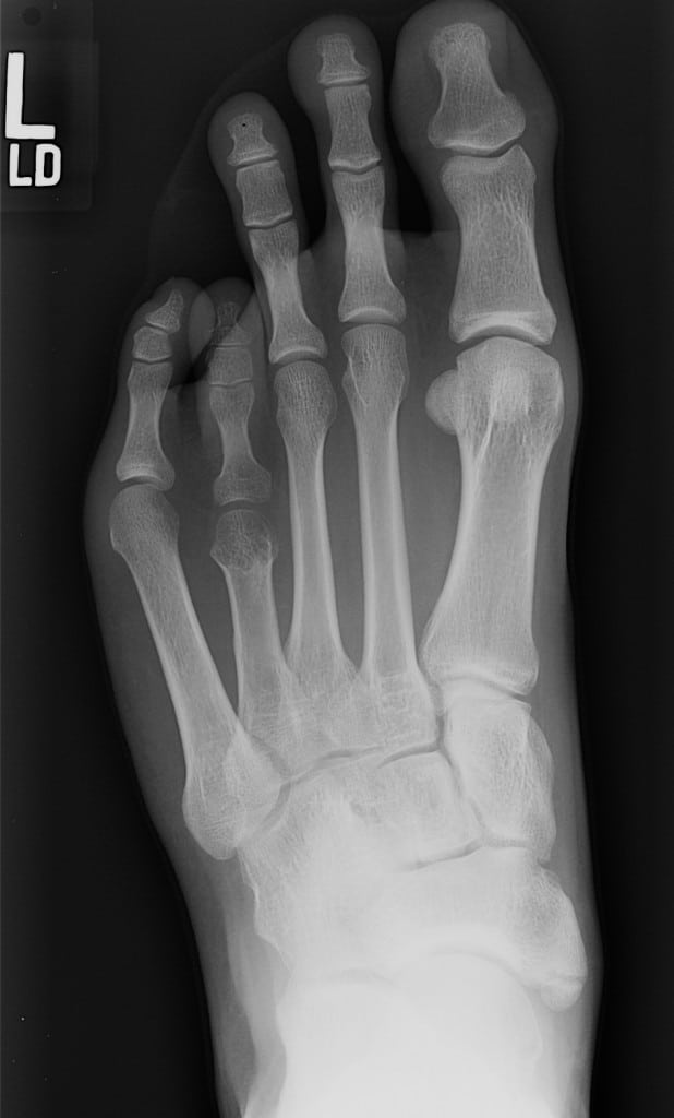 Brachymetatarsia | Southern California Foot & Ankle Specialists