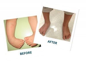 Clubfoot - Ladera Ranch Podiatrist | SCF&AS
