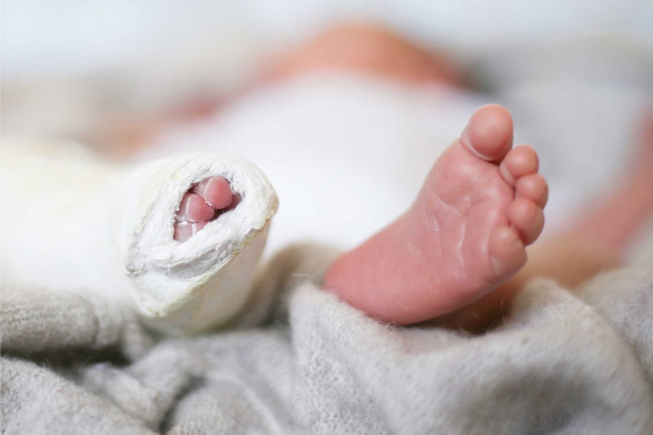 Ponseti Clubfoot Casting - Southern California Foot & Ankle Specialists