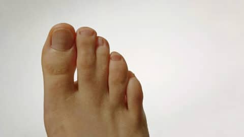 Why Does My Baby Has Webbed Toes - Southern California Foot & Ankle ...