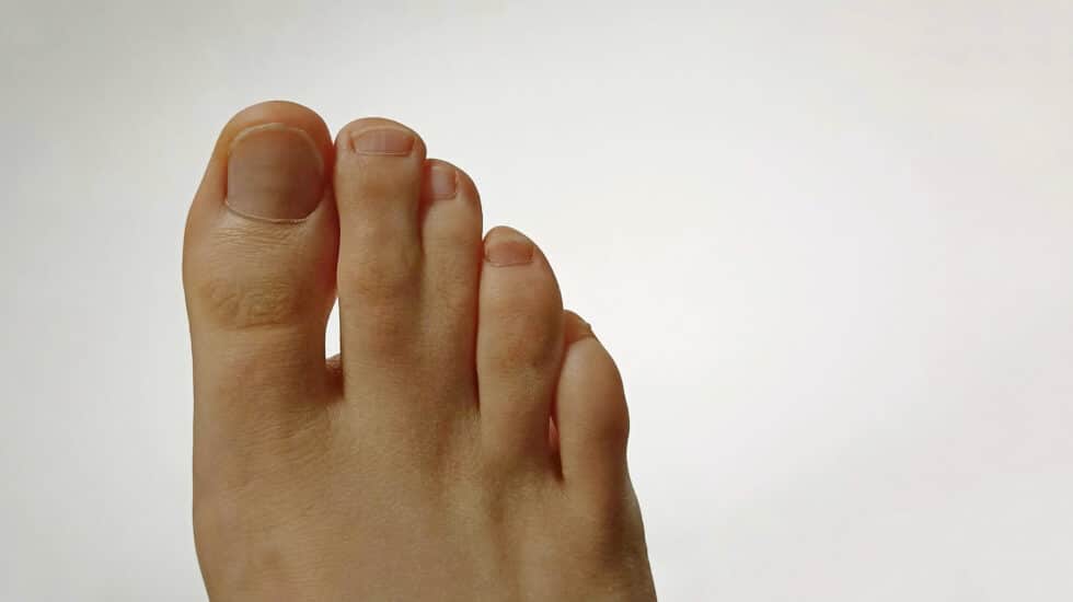 Why Does My Baby Has Webbed Toes - Southern California Foot & Ankle ...
